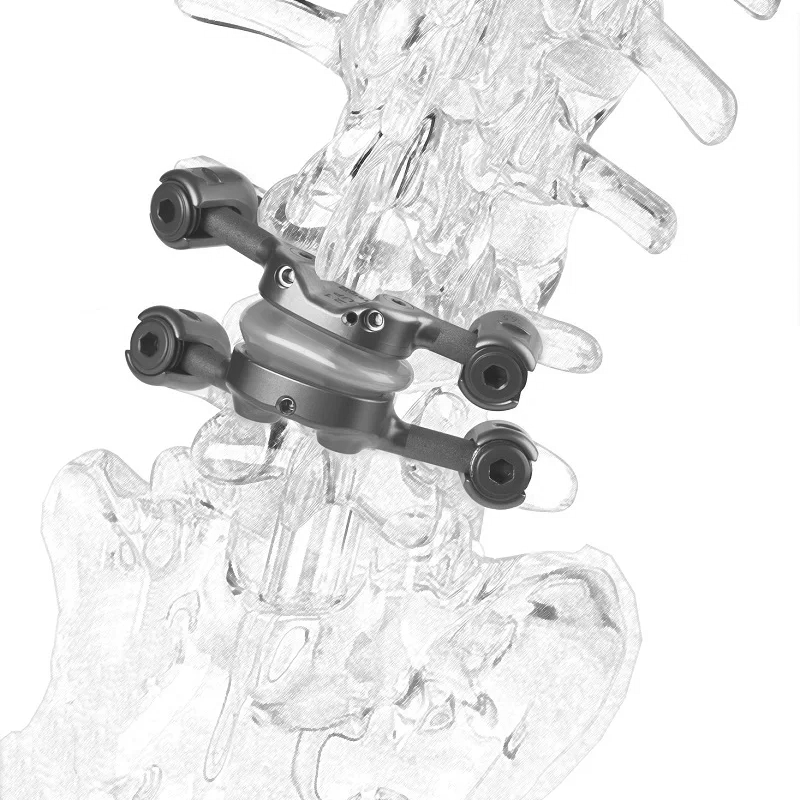 TOPS™ Posterior Arthroplasty System - Dr. Mark Frenkel MD ...